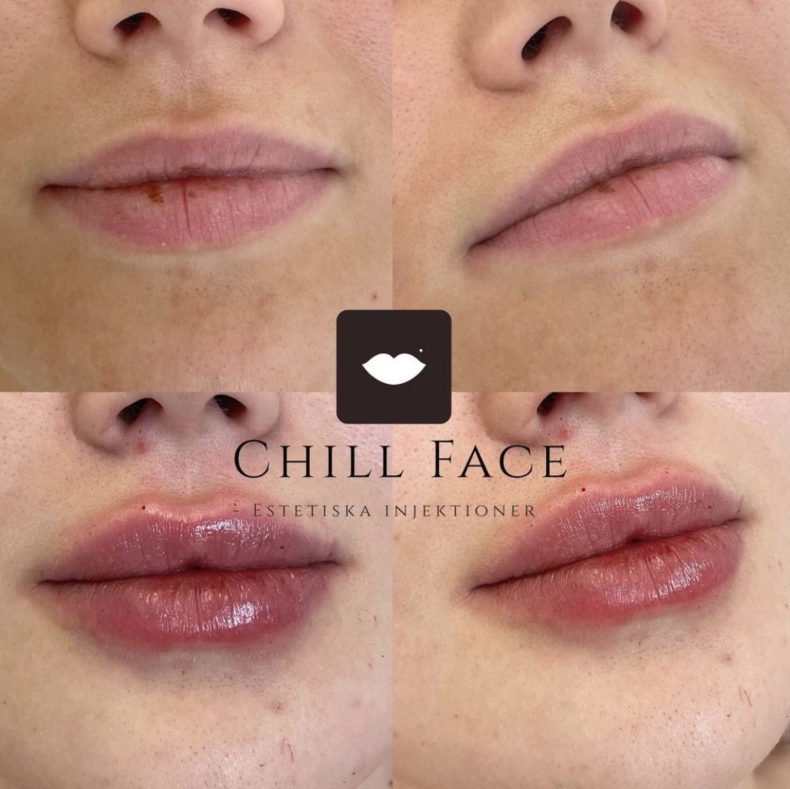 Chill Face- Estetiska injektioner, Gävle - Bokadirekt