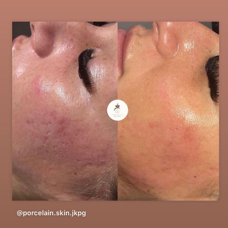 Porcelain Skin, Jönköping - Bokadirekt