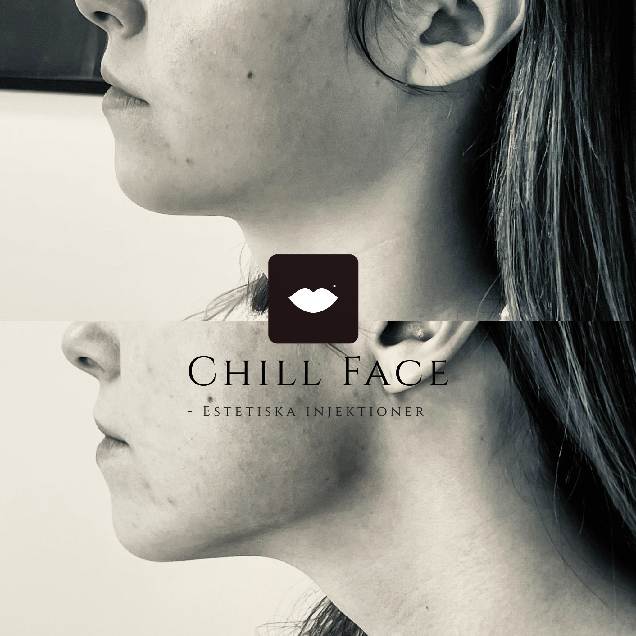 Chill Face- Estetiska injektioner, Gävle - Bokadirekt